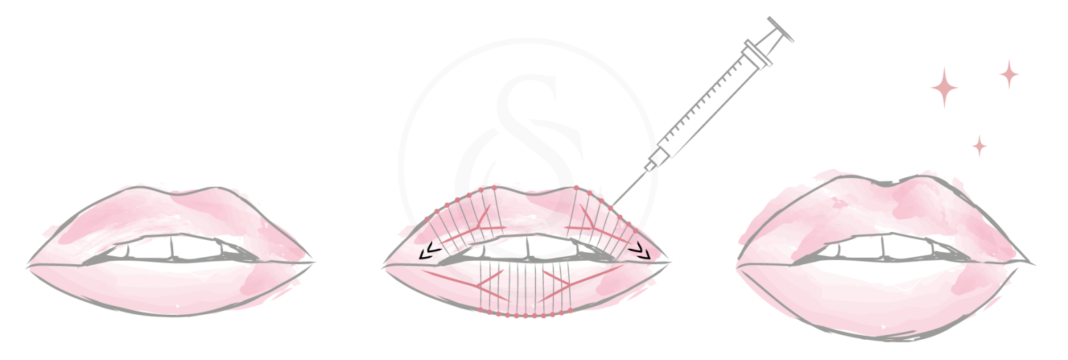 Lipfillers - natuurlijk resultaat bij Sarasin Clinic