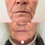 Filler smoking lines | Lip rejuvenation | Sarasin Clinic