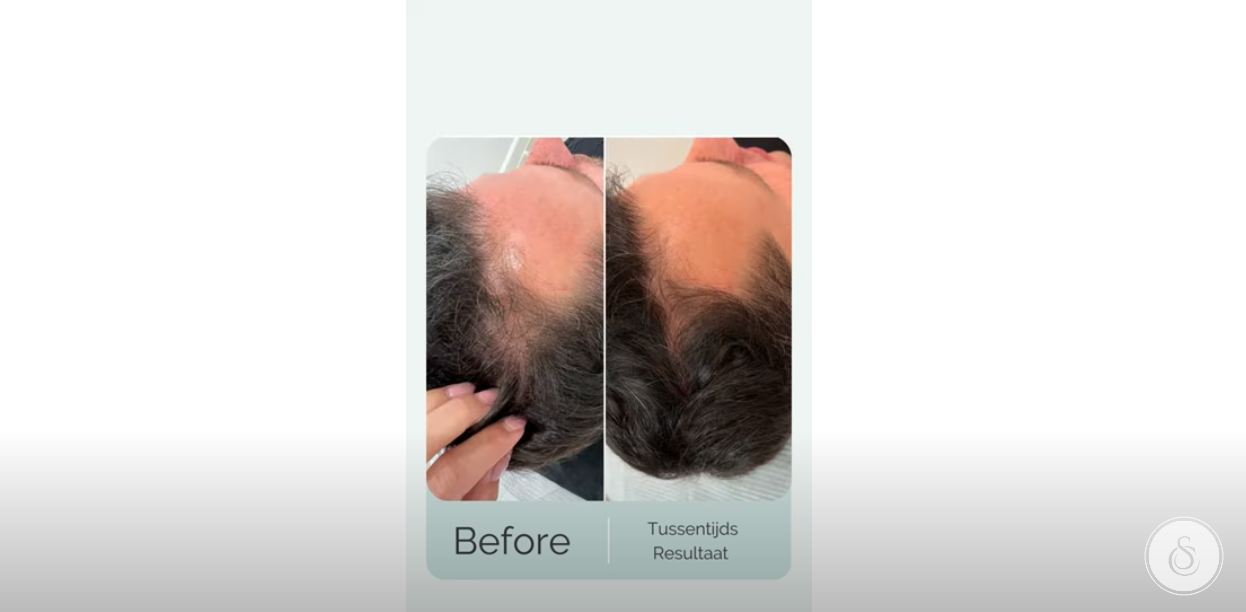 Hair Filler results - Sarasin Clinic