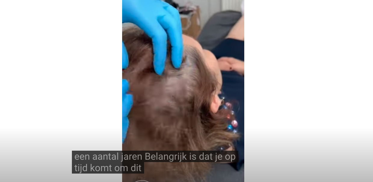 Haarverlies vrouwen - Sarasin Clinic