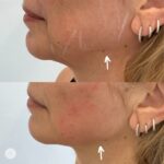 Radiesse: natural facelift | Sarasin Clinic