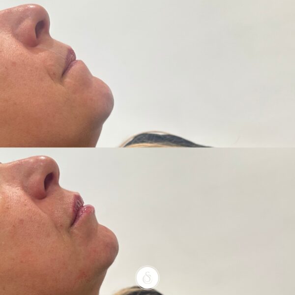 Lipfillers - natuurlijk resultaat bij Sarasin Clinic